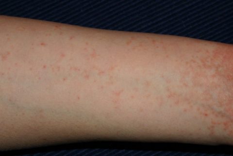 Scabies in Children - Pediatric Center